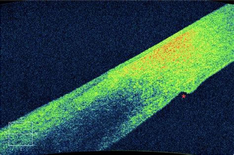 Evaluation Of Corneal Incision In Femtosecond Laser Assisted