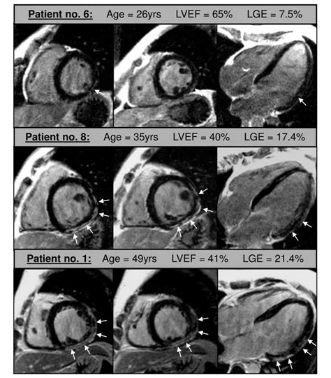 Ppt Patient No 6 Age 26yrs Lvef 65 Lge 75 Powerpoint