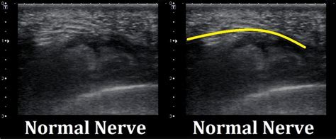 Clinical Ultrasound Imaging Of Interdigital Neuromas
