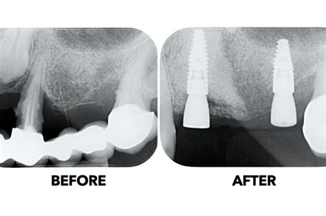 Reconstruction Of A Complex Post Extraction Defect Using Novamag