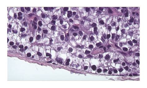 Parathyroid Adenoma A The Patient Underwent Minimally Invasive Download Scientific Diagram