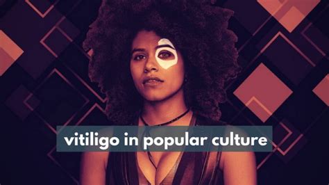 Famous Vitiligans 56 Celebrities With Vitiligo Unite For Vitiligo