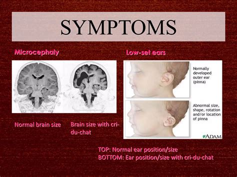 Cri Du Chat Syndrome Pptx