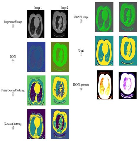 Hybrid Transformer Cnn And Lstm Model For Lung Disease Segmentation And Classification [peerj]