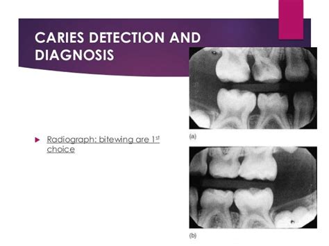 Detection Diagnosis And Prevention Of Dental Caries