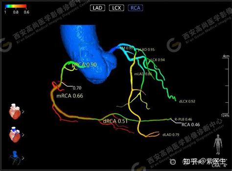 高尚医学影像之冠状动脉CT血流储备分数AI定量分析CT FFR 知乎