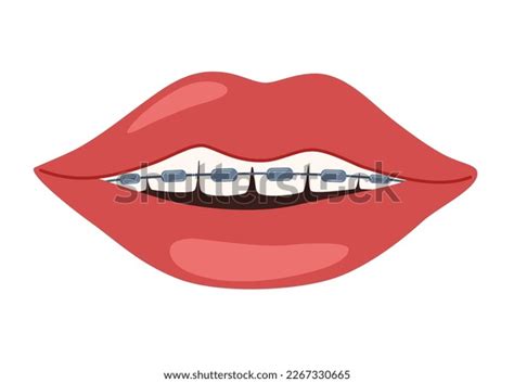 Mouth Braces On Teeth Installing Braces Stock Vector Royalty Free