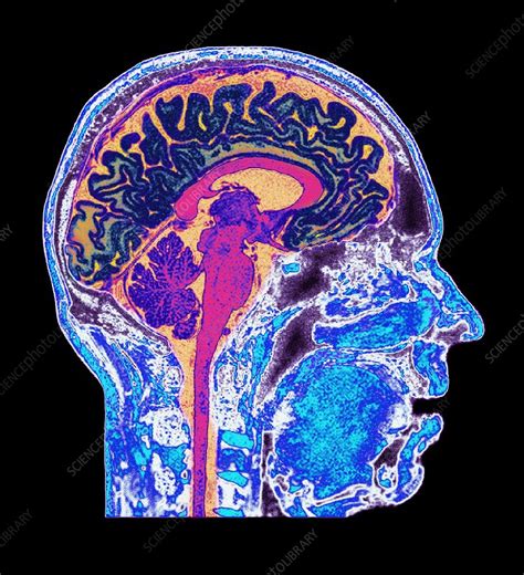 Normal Human Brain Mri Scan Stock Image C0168844 Science Photo