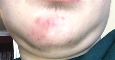 Infected Pimple Album On Imgur