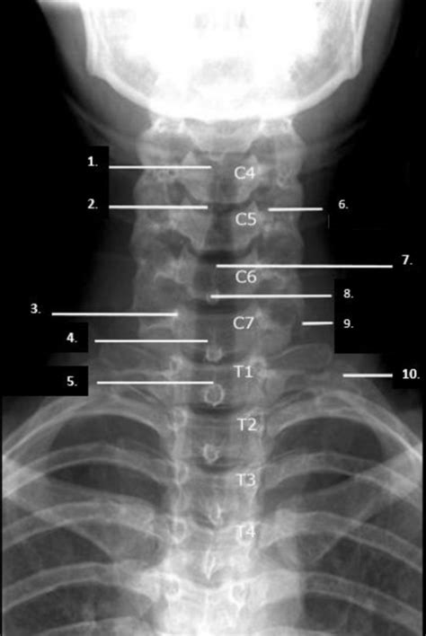 Pro Ap C Spine Diagram Quizlet