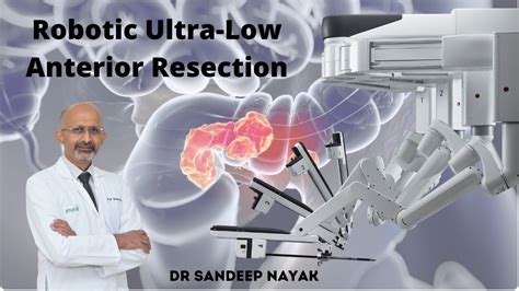 Robotic Ultra Low Anterior Resection For Rectal Cancer By Dr Sandeep Nayak Bangalore YouTube