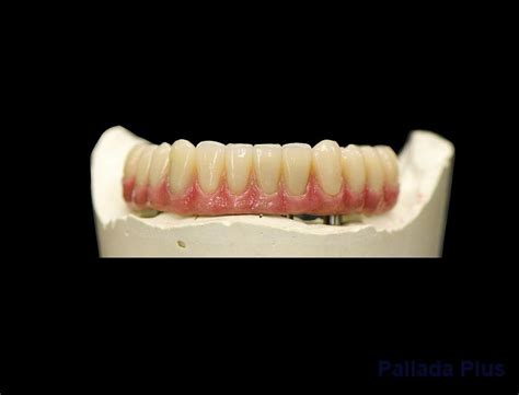 Работа на имплантах Палада плюс