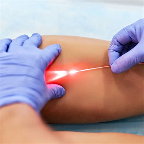 Endovenous Laser Ablation Premier Vein And Vascular