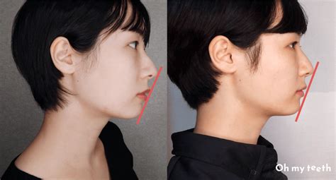 歯科矯正で横顔はきれいになる？症例別の変化と変わらない人の特徴を解説