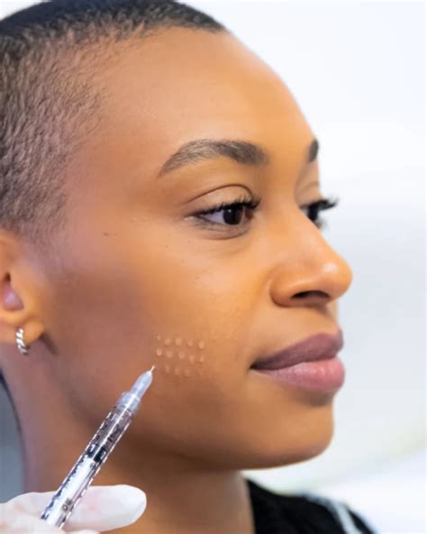 Skin Boosters Injections Srgn Clinic