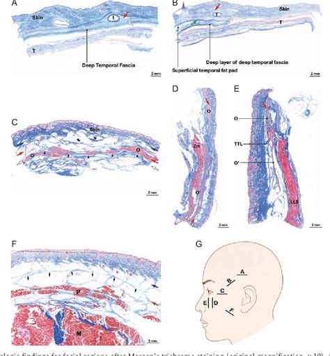 Figure 3 From Bilayered Structure Of The Superficial Facial Fascia