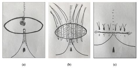 Surgical Procedure A The Planned Line Of Elliptic Excision Contains