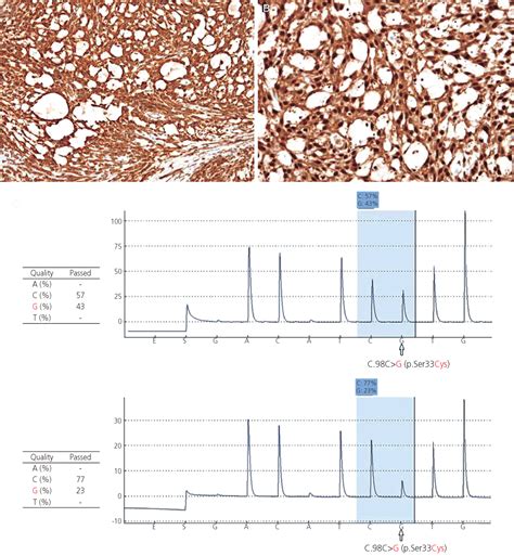 Ovarian Microcystic Stromal Tumor Semantic Scholar