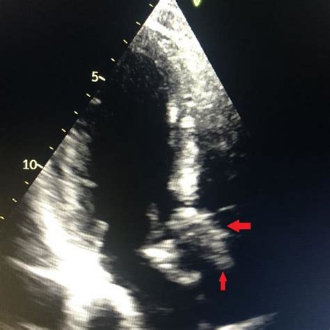 Vegetation On The Aortic Valve In Transthoracic Echocardiography