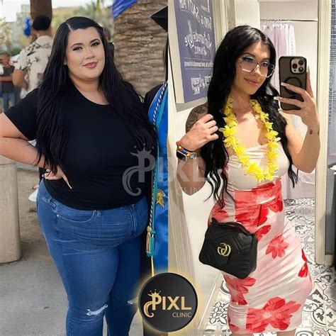 Gastric Sleeve Before And After Pixl Clinic