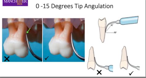 Ultrasonic Scaling Session 2 Flashcards Quizlet