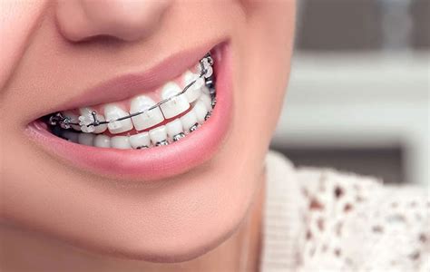 ارتودنسی با براکت سرامیکی مزایا و مراحل درمان