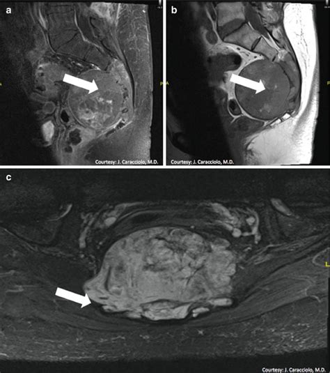 Biopsy And Staging Of Sacral Tumors Radiology Key