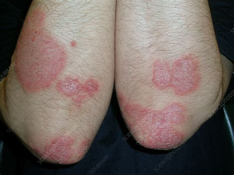 Psoriasis Stock Image C0561058 Science Photo Library