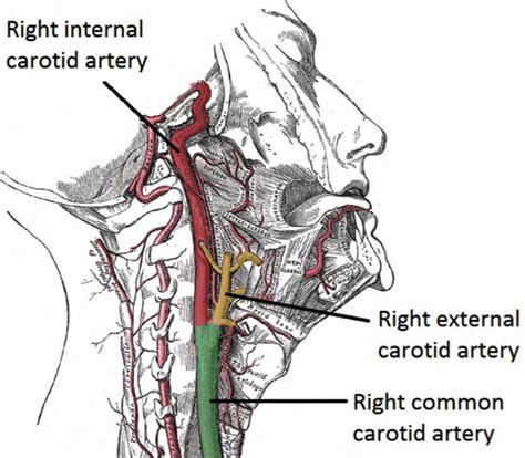 Carotid Artery Disease Clinical Features Management Teachmesurgery