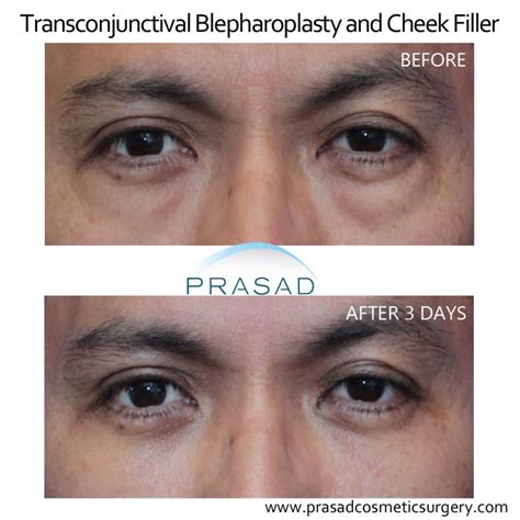 Eye Bag Surgery Lower Blepharoplasty Recovery Process