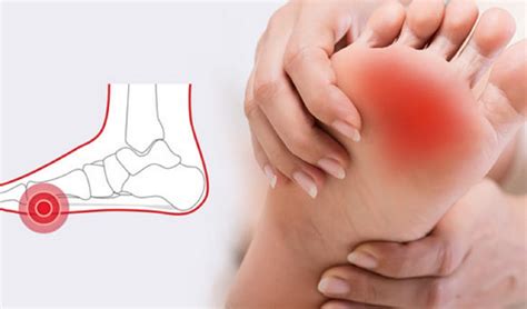 Metatarsalgjia Dhimbja E Shputës Së Këmbës Simptomat Dhe Trajtimi