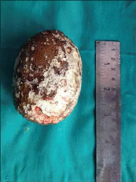 Bladder Stone Rmedicalgore