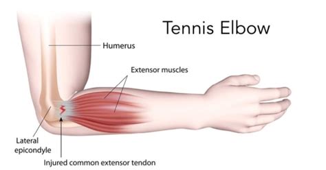 Wrist Extensor Tendons