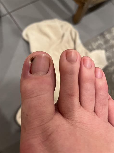 Day 3 Recovery Partial Avulsion And Matrixectomy So Far So Good And