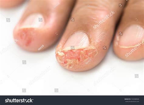 Fingernail Skin Peeling
