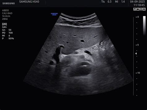 Dissection Aortique Societe Nationale Déchographie En Médecine Générale