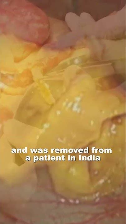 Biggest Tapeworm Ever Removed From A Human Youtube