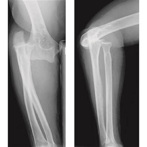 The Elbow Arthrography Revealed A Complete Tear Of The Medial