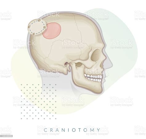 Craniotomy Surgery Bone Flap Removal Stock Illustration Stock