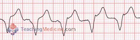 Qrs Detection Based On Wavelet Coefficients