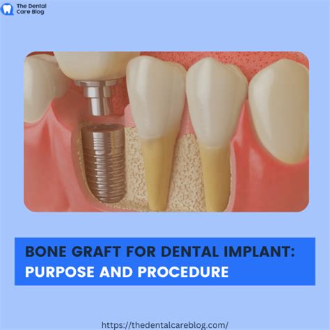 Dental Abscess Bone Graft At Matthew Gibbs Blog