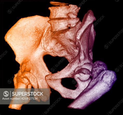 Dislocation Of The Hip 3d Computed Tomographic Ct Reconstruction