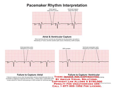 Amicus Illustration Of Amicuschartpacemakerheartrhythmatrial