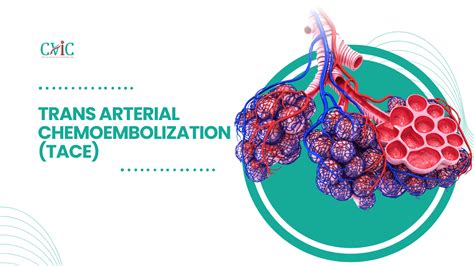 Navigating Cancer Treatment Trans Arterial Chemoembolization