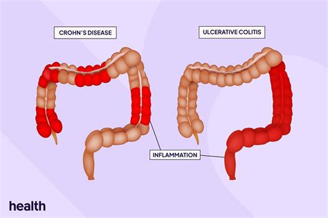 What To Know About Crohns Disease And Colitis Crohns Disease