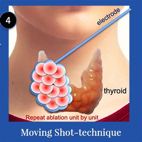 Microwave Ablation Treatment Prathamesh Ent Clinic
