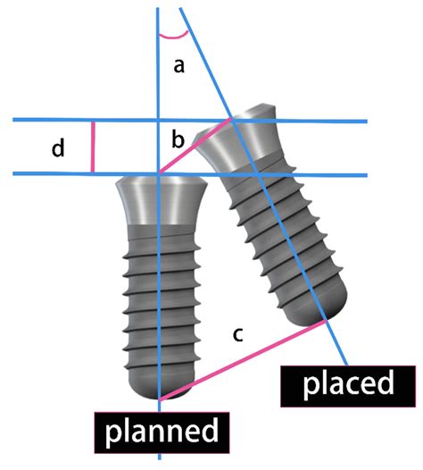 Influence Of Bone Conditions On The Accuracy Of Implant Placement