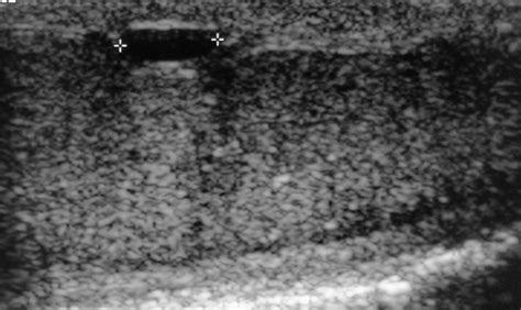 Ectasia Tubular De La Rete Testis Y Otras Lesiones Escrotales Benignas