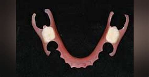 Valplast Flexible Aesthetic Partial Dentures Dental Economics