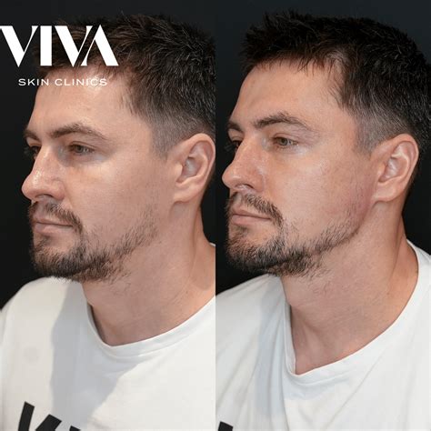 Masseter Botox London Jawline Slimming